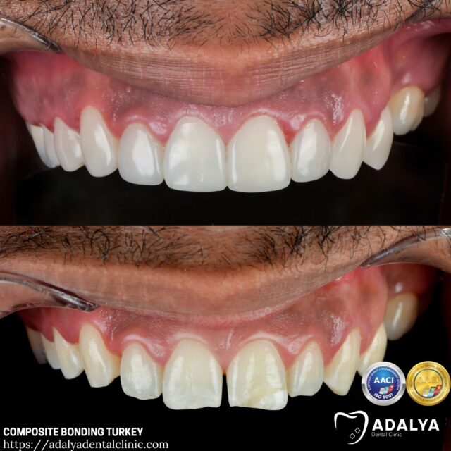 Composite Bonding Before and After - Adalya Dental Clinic
