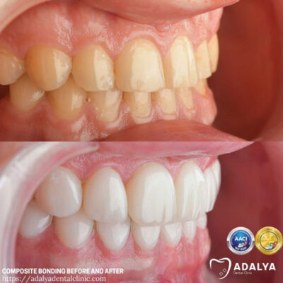 Composite Bonding Before and After - Adalya Dental Clinic