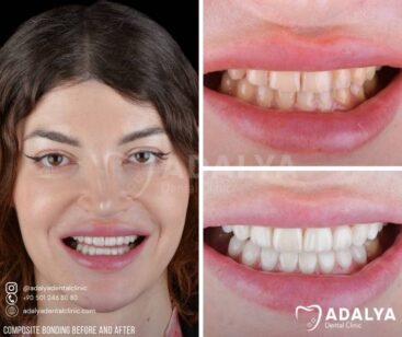 Turkey Teeth Veneers Before and After | Adalya Dental Clinic