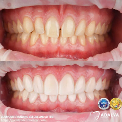 Composite Bonding Before and After - Adalya Dental Clinic