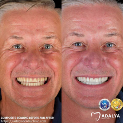 Composite Bonding Before and After - Adalya Dental Clinic