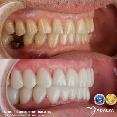 Composite Bonding Before and After - Adalya Dental Clinic