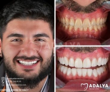 Turkey Teeth Veneers - Affordable Dental Veneer Price in Antalya