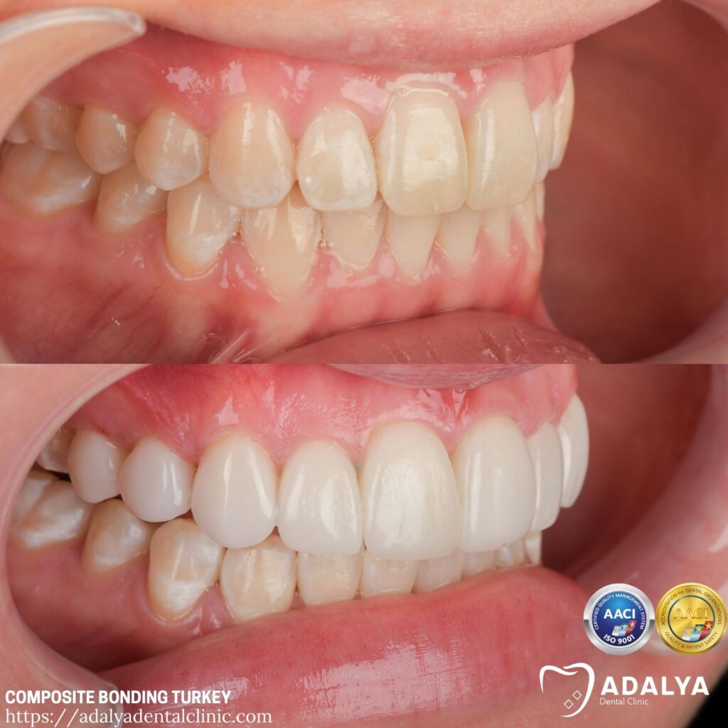 Composite Bonding Before and After - Adalya Dental Clinic