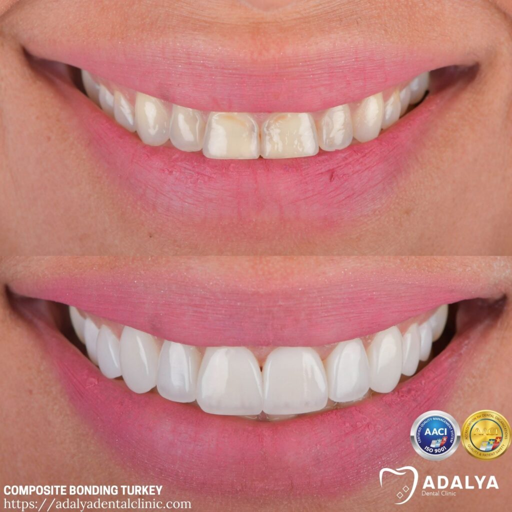 Composite Bonding Before and After - Adalya Dental Clinic