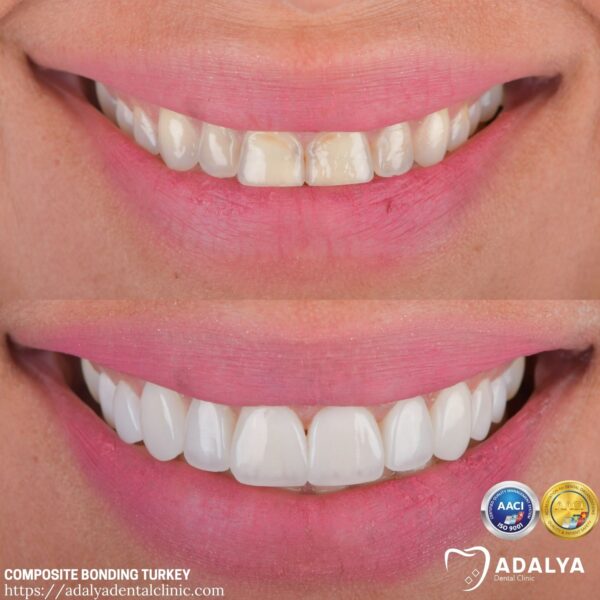 Composite Bonding Before and After - Adalya Dental Clinic