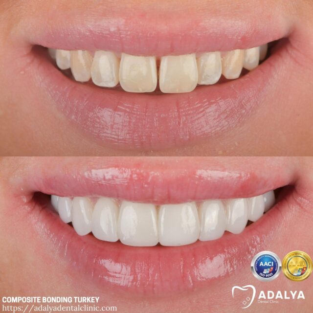 Composite Bonding Before and After - Adalya Dental Clinic