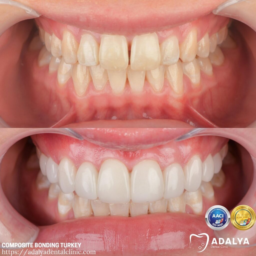 Composite Bonding Before and After - Adalya Dental Clinic