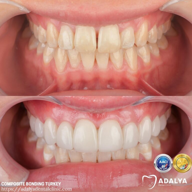 Composite Bonding Before and After - Adalya Dental Clinic