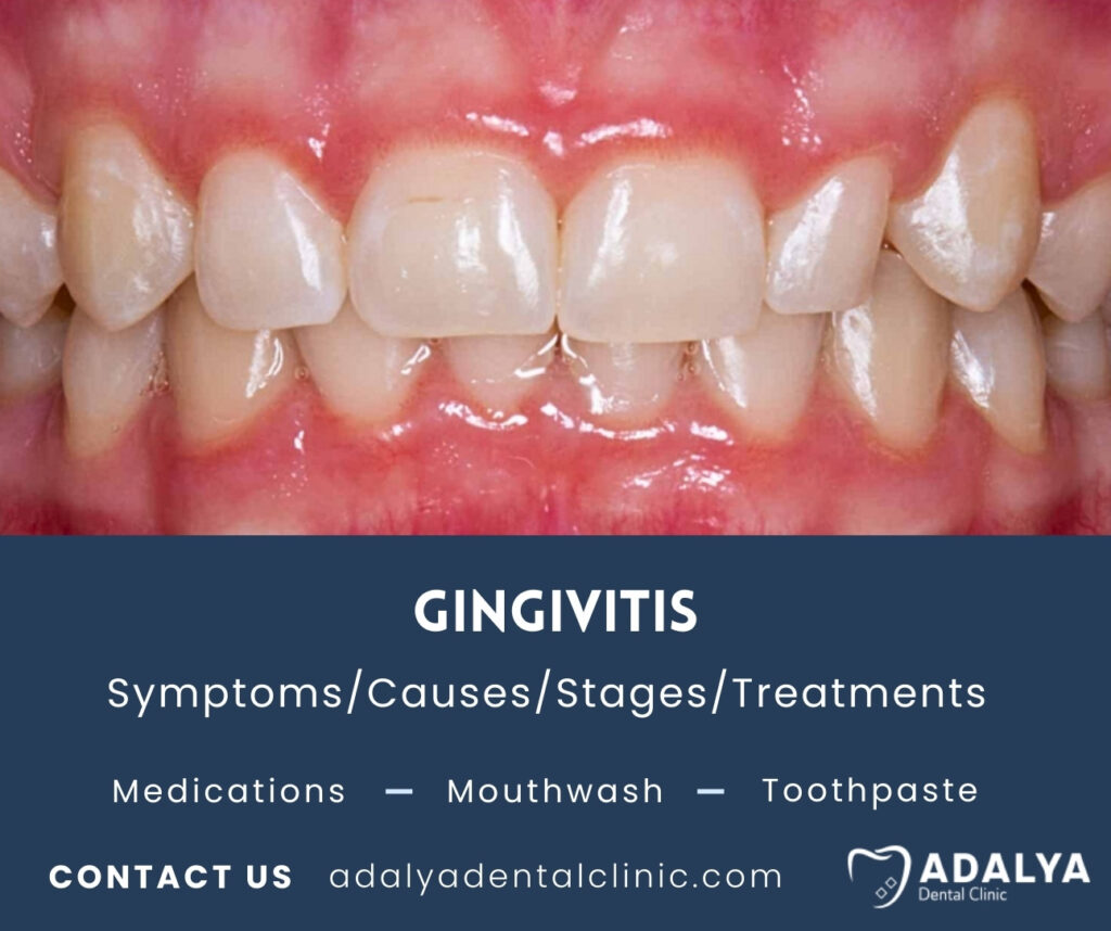 Gingivitis: Symptoms, Causes, Treatment | Adalya Dental Clinic