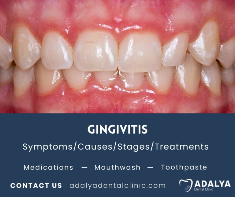 Gingivitis: Symptoms, Causes, Treatment | Adalya Dental Clinic