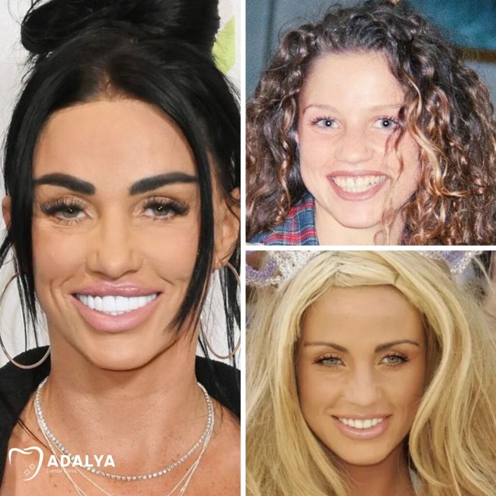 Katie Price Teeth: Before & After Veneers Journey | Adalya Clinic