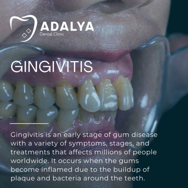 Gingivitis: Symptoms, Causes, Treatment | Adalya Dental Clinic