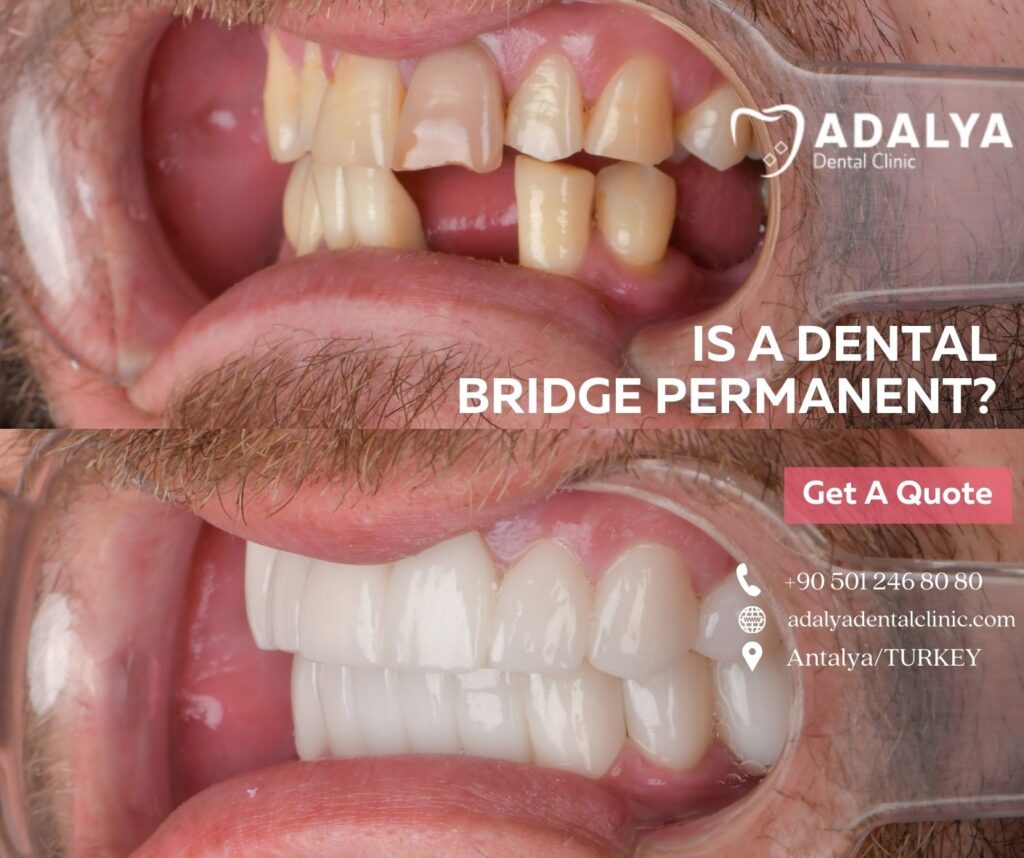 Is A Dental Bridge Permanent? - Adalya Dental Clinic