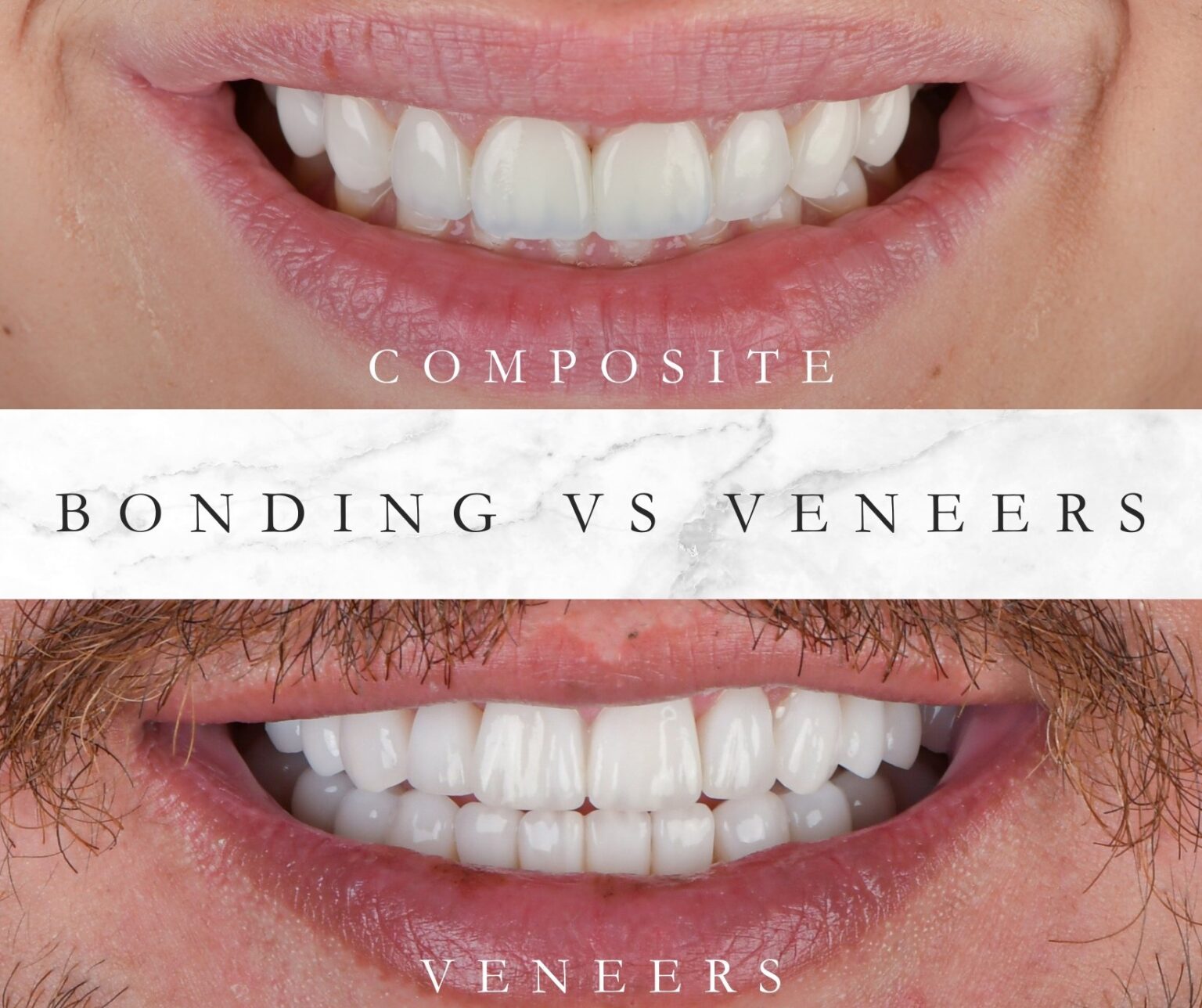 Composite Bonding vs Veneers: Key Differences For Teeth