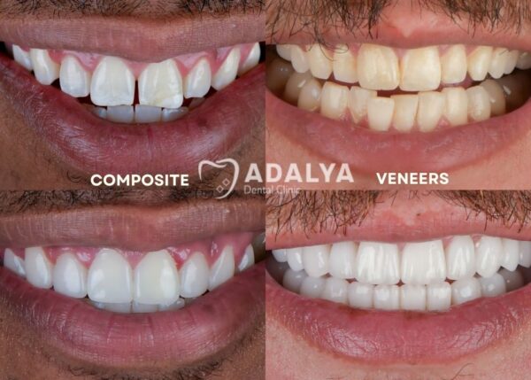 Composite Bonding vs Veneers: Key Differences For Teeth
