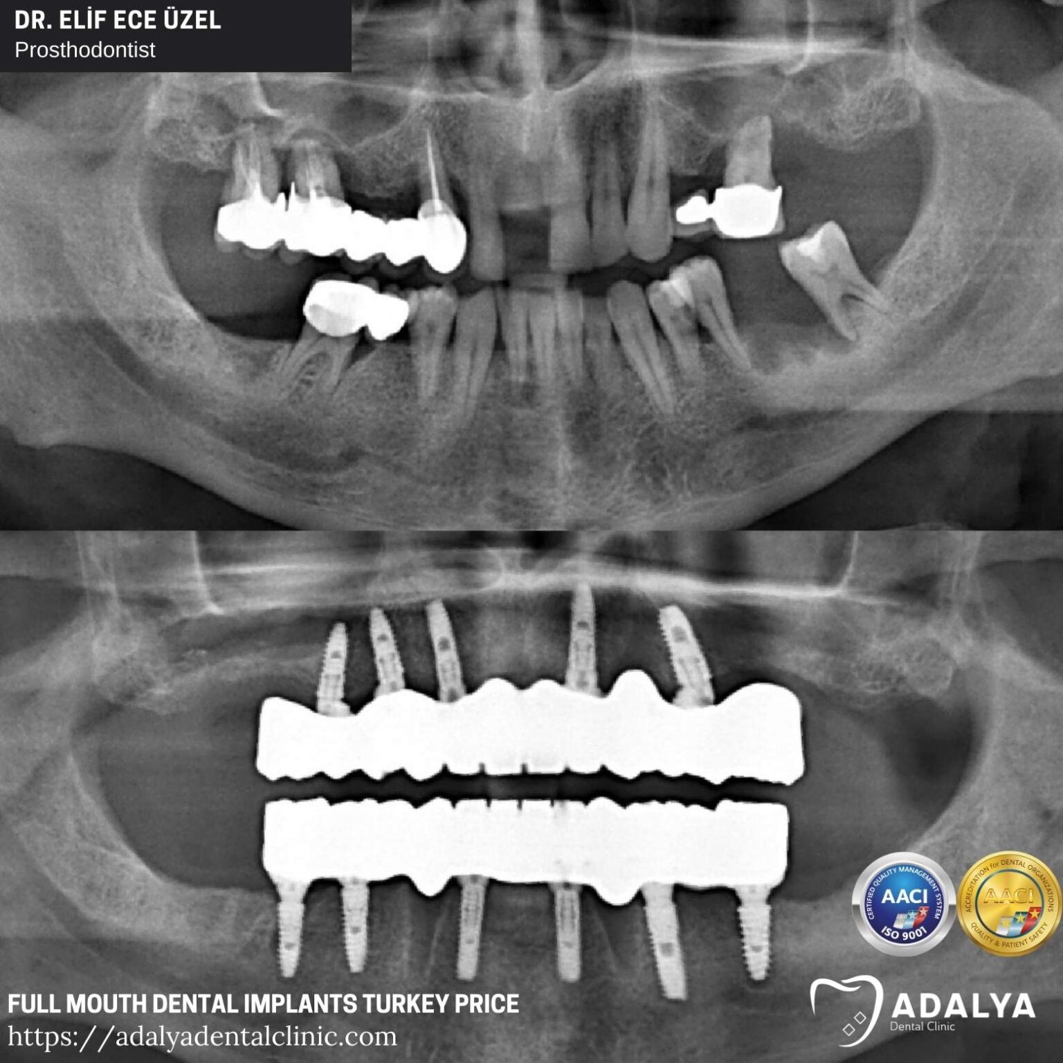 Full Mouth Dental Implants Turkey Price 2025 | Adalya Dental Clinic