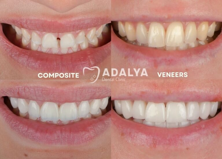 Composite Bonding vs Veneers: Key Differences For Teeth