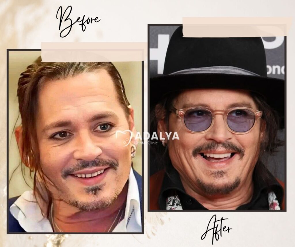 Johnny Depp Teeth: New, Rotting, Before & After Teeth Journey