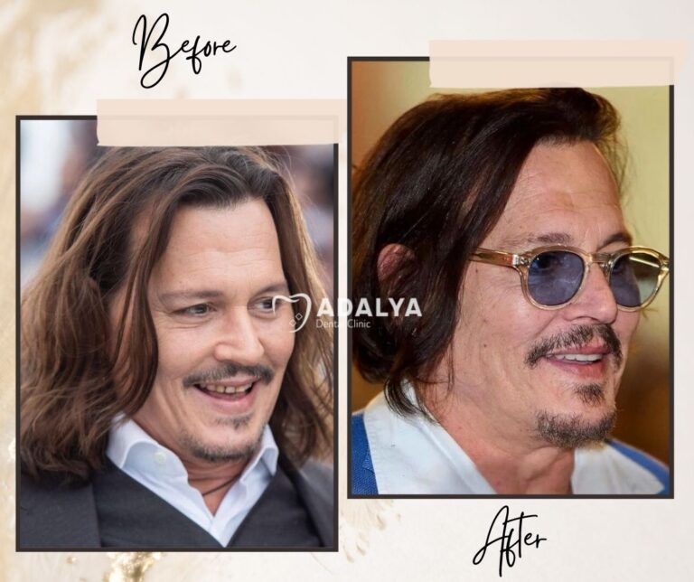 Johnny Depp Teeth: New, Rotting, Before & After Teeth Journey