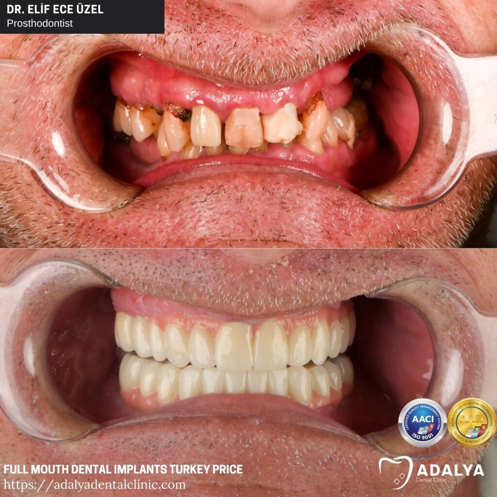 Full Mouth Dental Implants Turkey Price 2025 | Adalya Dental Clinic