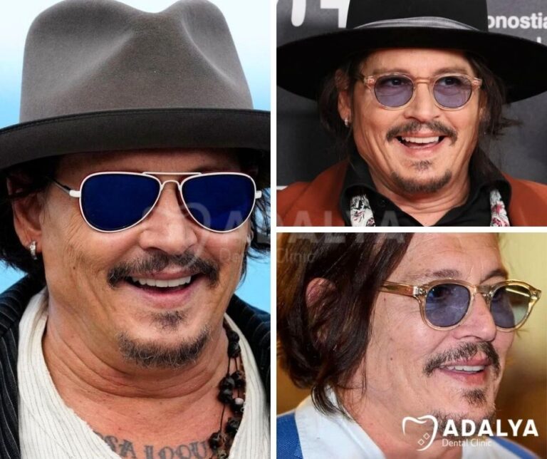 Johnny Depp Teeth: New, Rotting, Before & After Teeth Journey