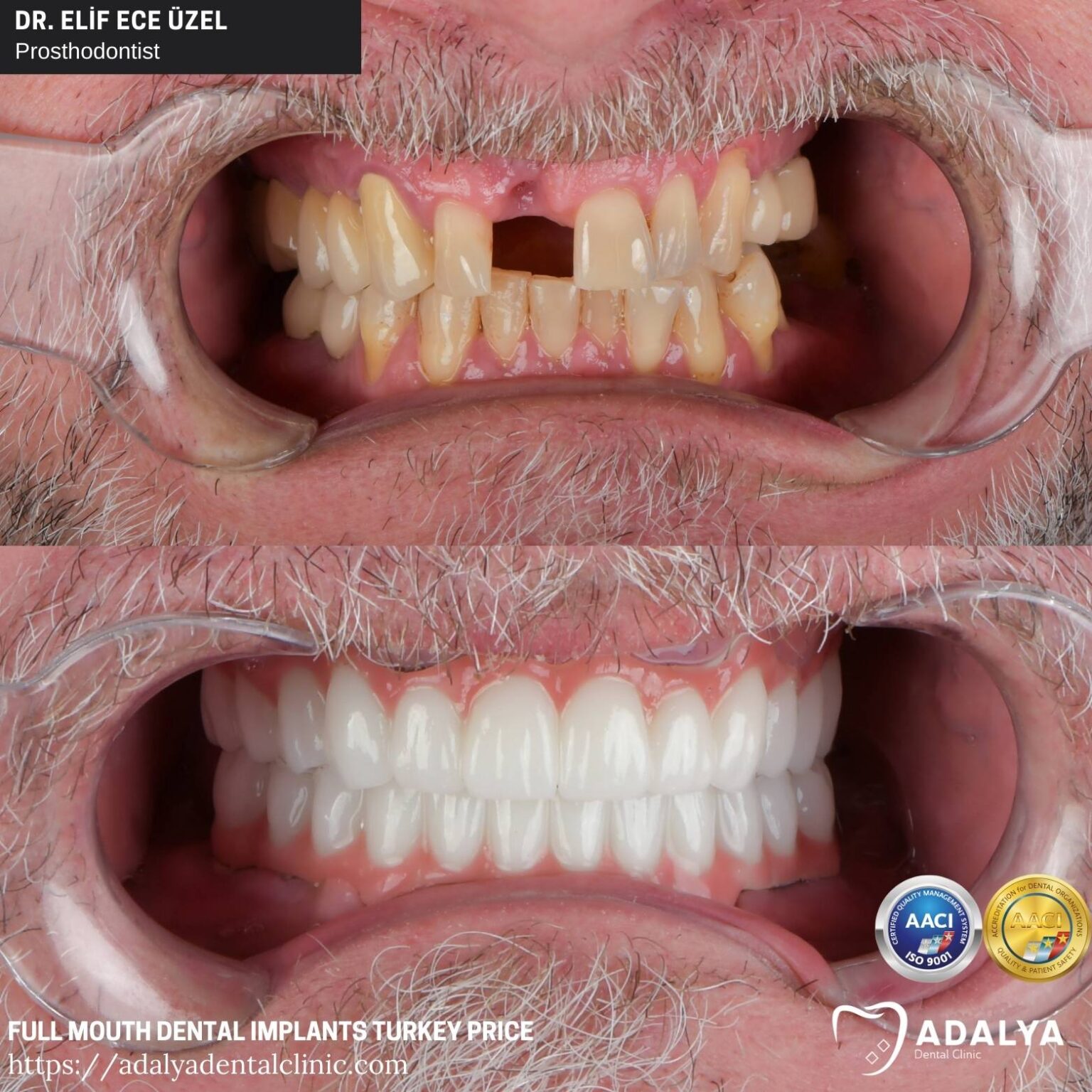 Full Mouth Dental Implants Turkey Price 2025 | Adalya Dental Clinic