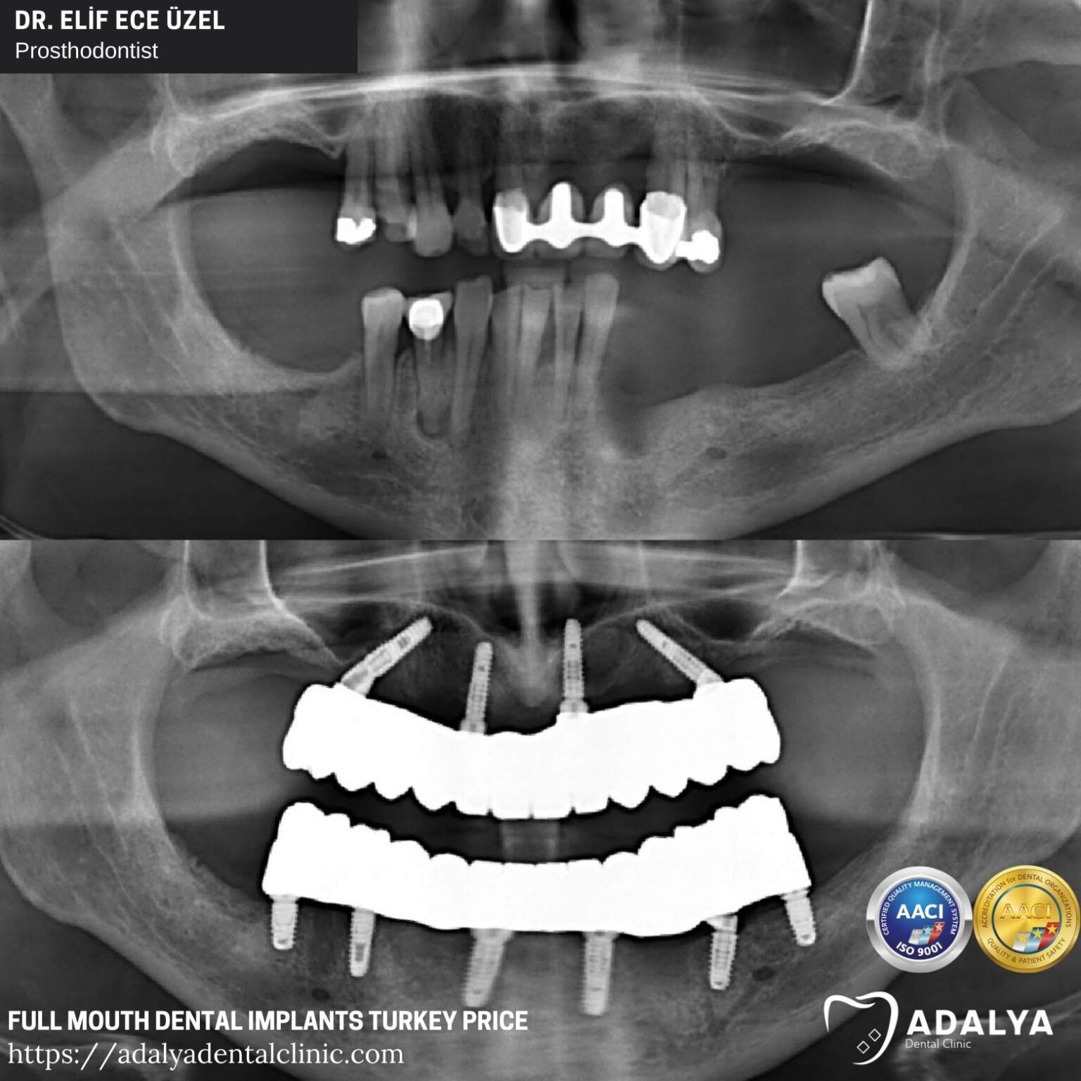 Full Mouth Dental Implants Turkey Price 2025 | Adalya Dental Clinic