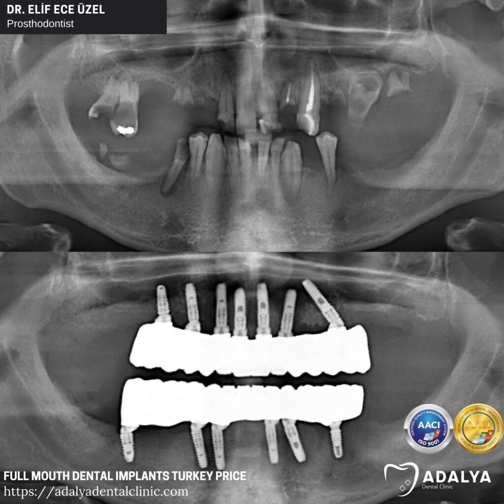 Full Mouth Dental Implants Turkey Price 2025 | Adalya Dental Clinic