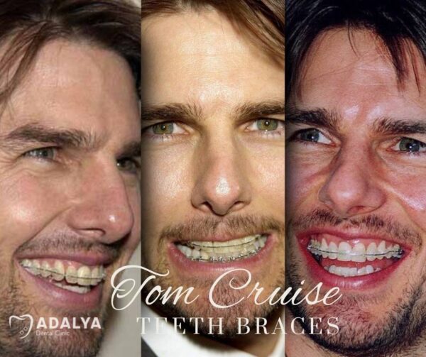 Tom Cruise Teeth: Before and After Journey, Teeth Line Problem
