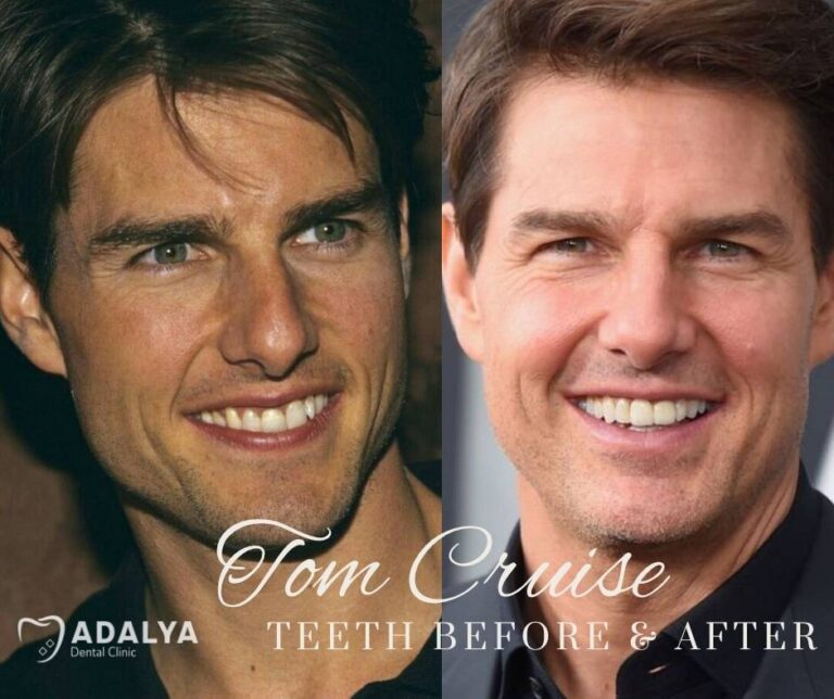 Tom Cruise Teeth: Before and After Journey, Teeth Line Problem