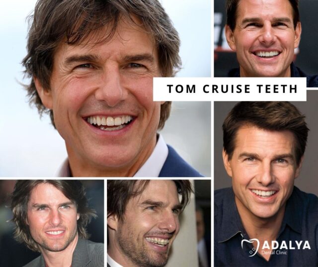 Tom Cruise Teeth: Before and After Journey, Teeth Line Problem