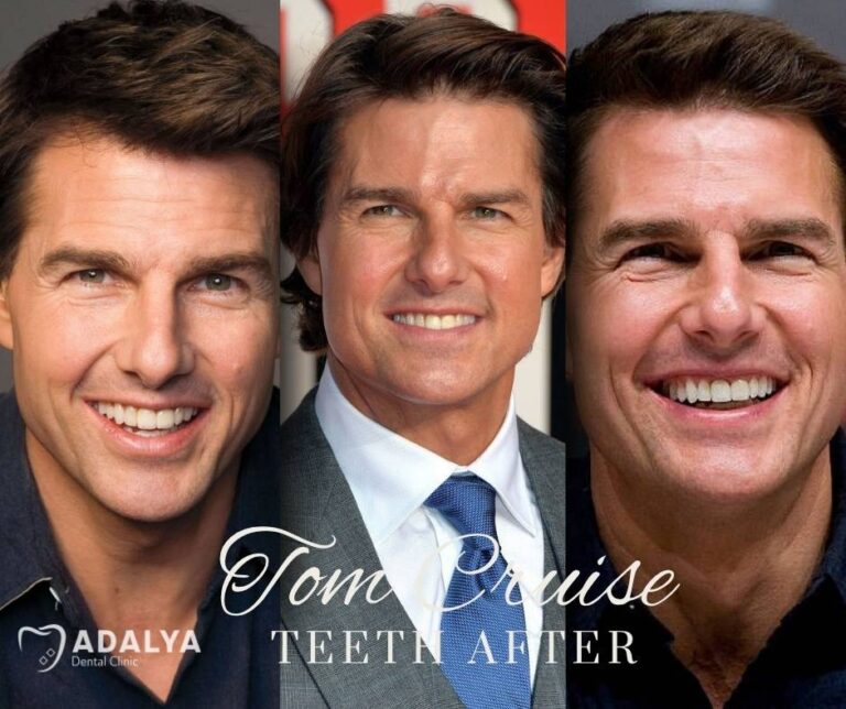 Tom Cruise Teeth: Before and After Journey, Teeth Line Problem