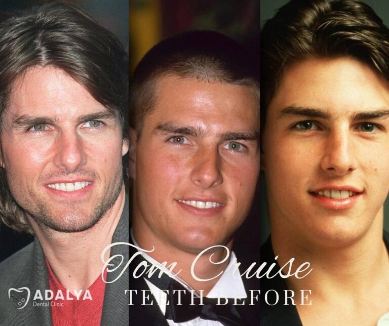 Tom Cruise Teeth: Before and After Journey, Teeth Line Problem