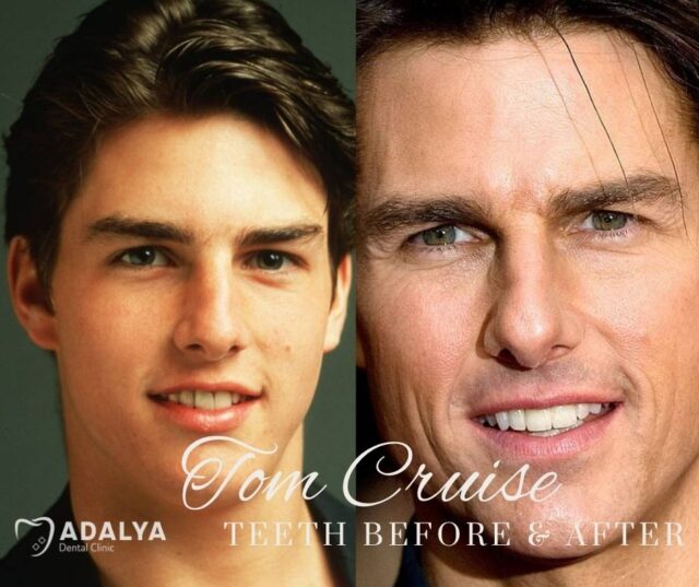 Tom Cruise Teeth: Before and After Journey, Teeth Line Problem