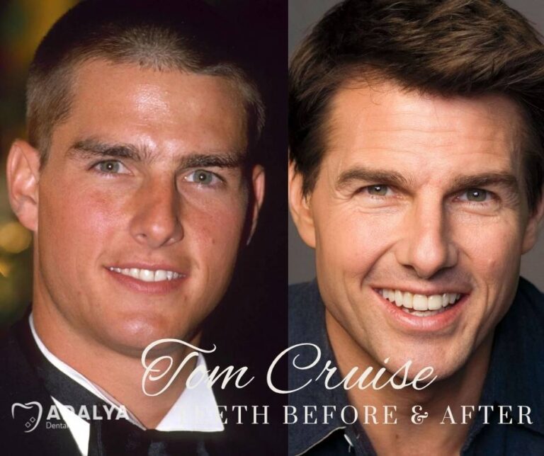 Tom Cruise Teeth: Before and After Journey, Teeth Line Problem