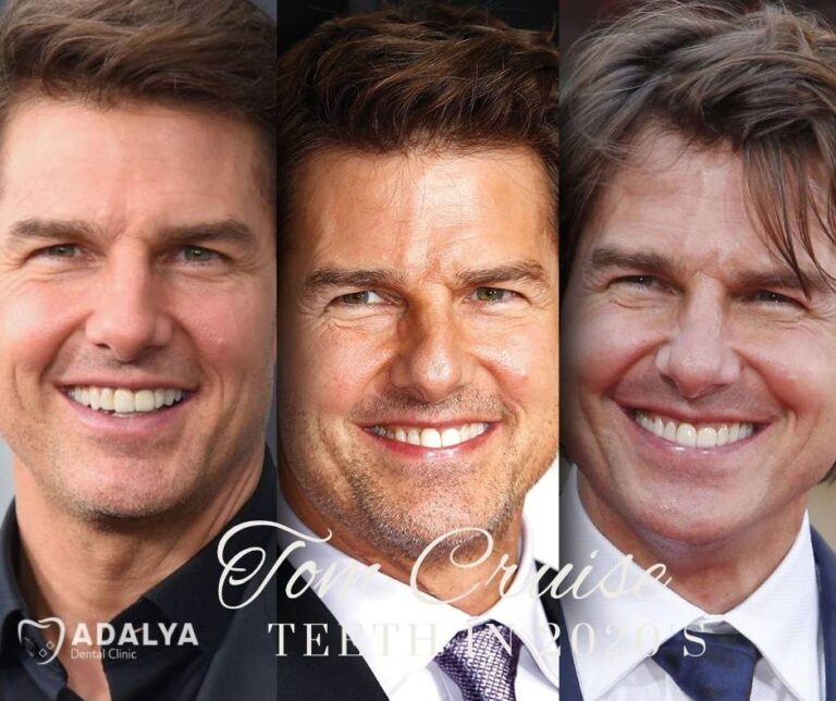 Tom Cruise Teeth: Before and After Journey, Teeth Line Problem