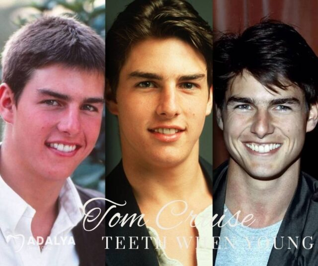 Tom Cruise Teeth: Before and After Journey, Teeth Line Problem