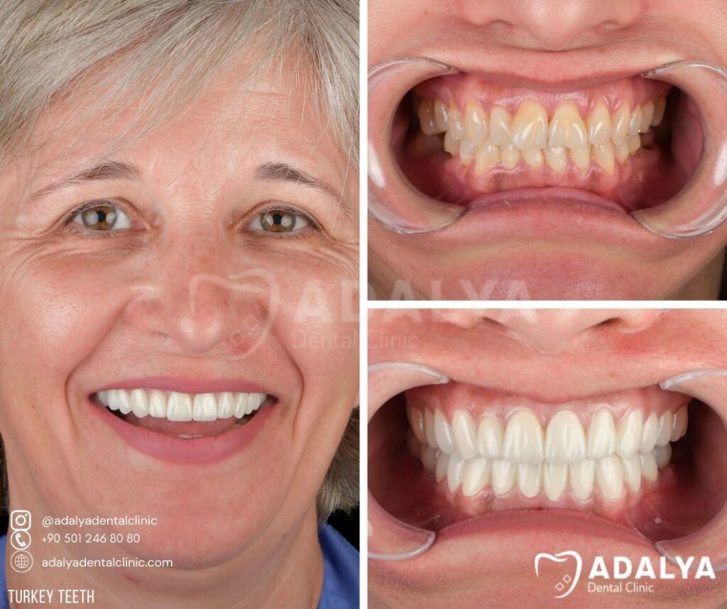 Turkey Teeth Veneers Before and After | Adalya Dental Clinic