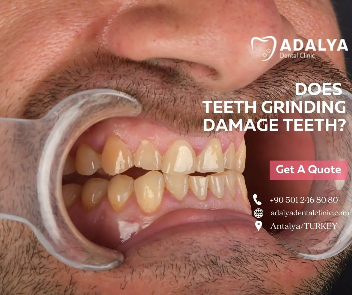Does Teeth Grinding Damage Teeth? - Effect On Teeth & Solutions