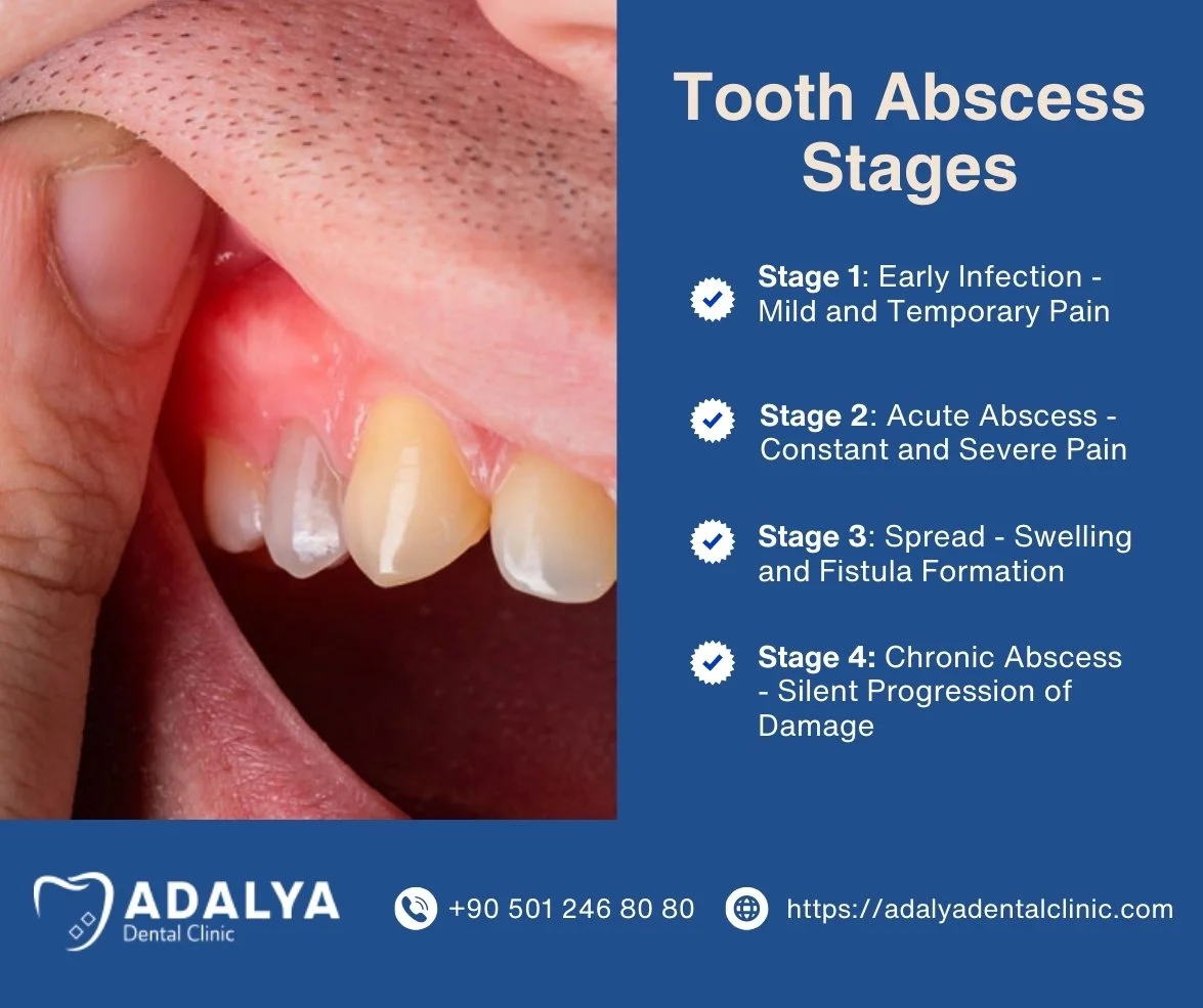 Tooth Abscess Stages: Early & Advanced Stages, Symptoms, Care
