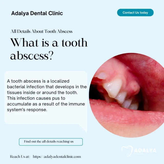 Tooth Abscess Stages: Early & Advanced Stages, Symptoms, Care